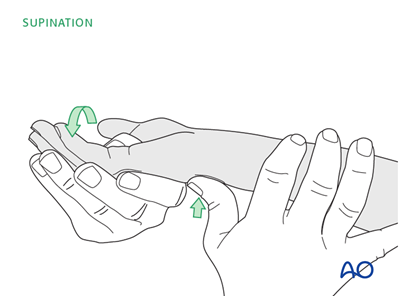 Closed reduction; long arm cast for Simple epiphysiolysis, Salter ...