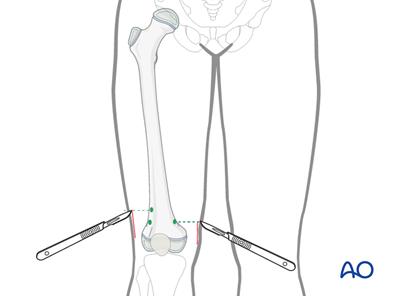 ESIN entry points for retrograde nailing of the pediatric proximal femur