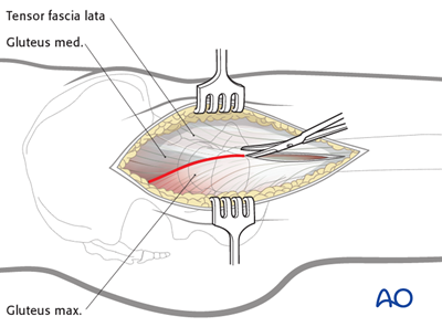 Transgluteal approach to the pediatric proximal femur