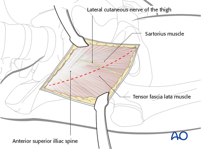 Anterior approach to the pediatric proximal femur
