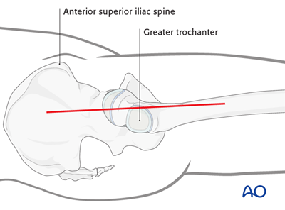 Transgluteal approach to the pediatric proximal femur