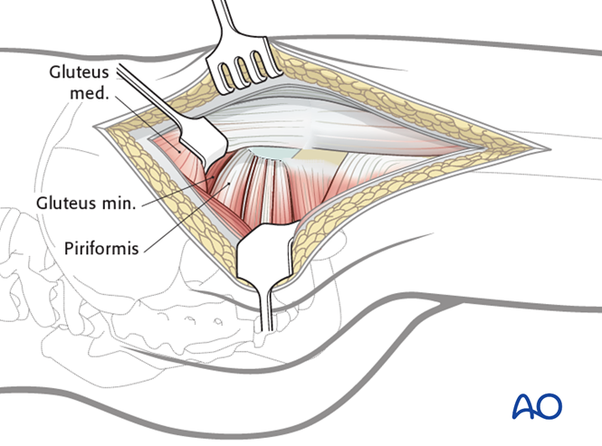 Pediatric surgical hip dislocation