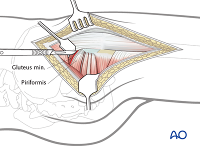 Pediatric surgical hip dislocation