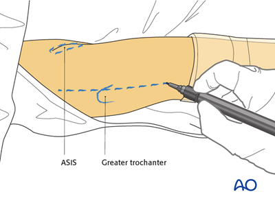 Transgluteal approach to the pediatric proximal femur