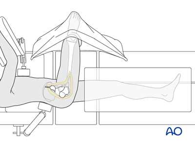 Pediatric surgical hip dislocation