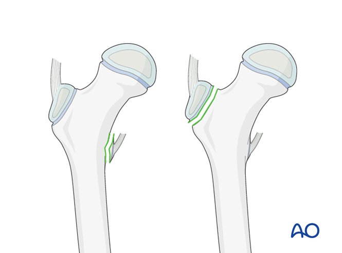 Avulsion of the greater or lesser trochanter