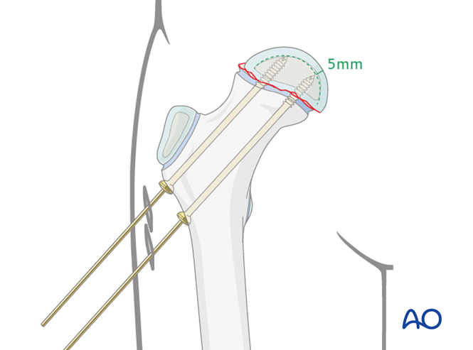 In situ fixation with K-wires or screws for Traumatic epiphysiolysis, SH I