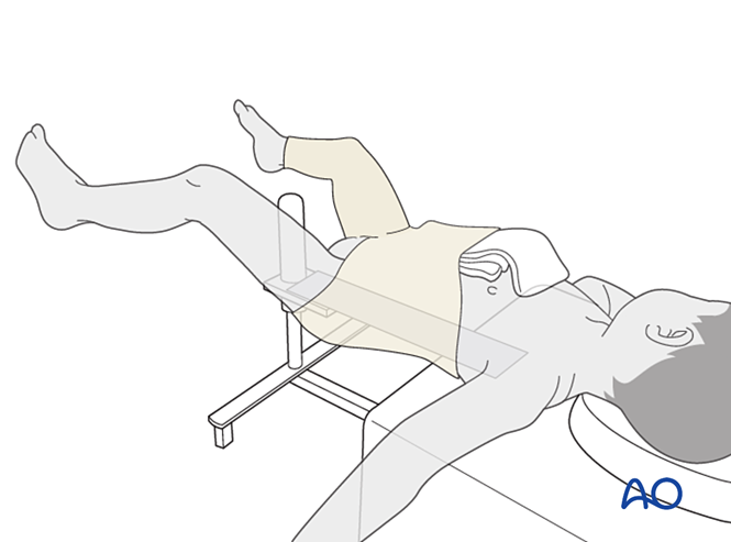 Hip spica for Traumatic epiphysiolysis, SH I