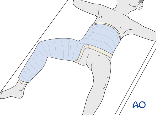 Hip spica for Incomplete basicervical