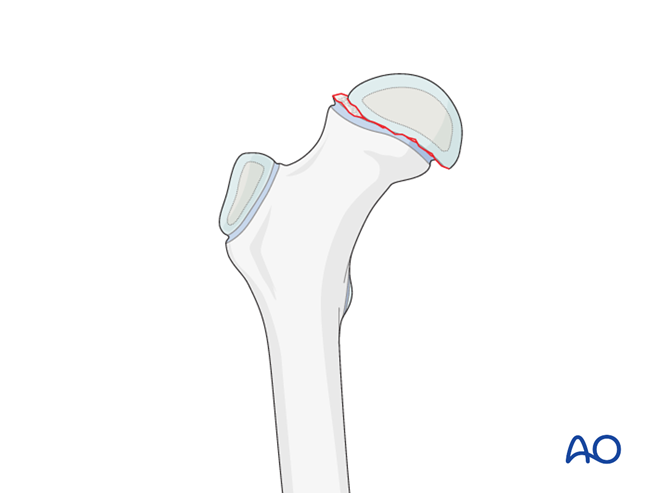 Open reduction, screw fixation for Traumatic epiphysiolysis, SH I