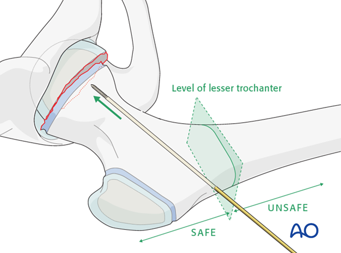 Open reduction, screw fixation for Traumatic epiphysiolysis, SH I