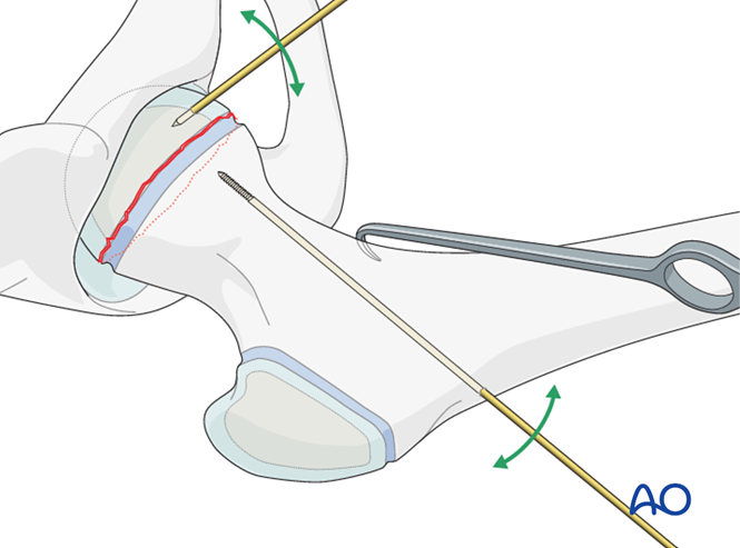 Open reduction, screw fixation for Traumatic epiphysiolysis, SH I