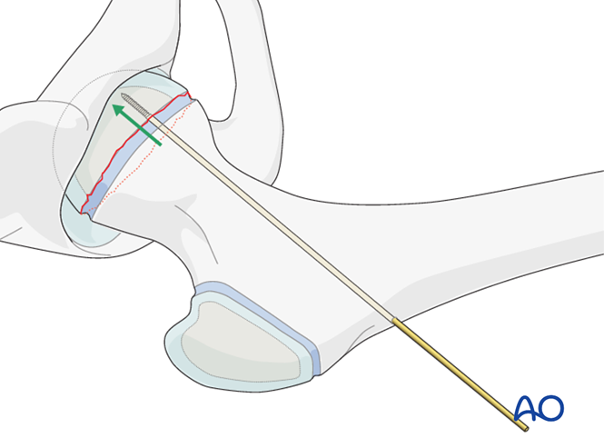 Open reduction, screw fixation for Traumatic epiphysiolysis, SH I