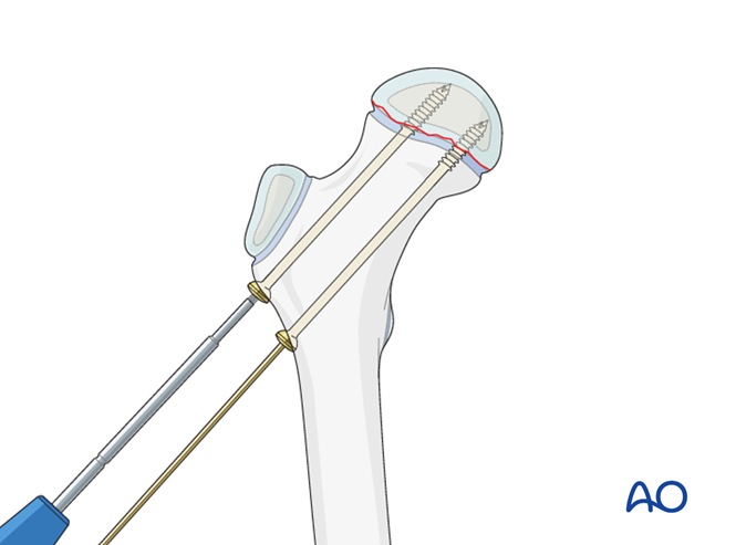 Open reduction, screw fixation for Traumatic epiphysiolysis, SH I