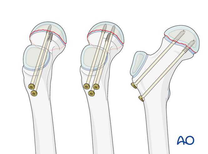 Open reduction, screw fixation for Traumatic epiphysiolysis, SH I