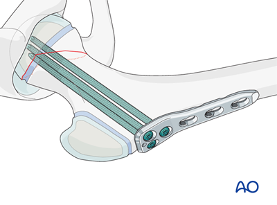 Open reduction, pediatric hip locking plate for Epiphysiolysis with ...