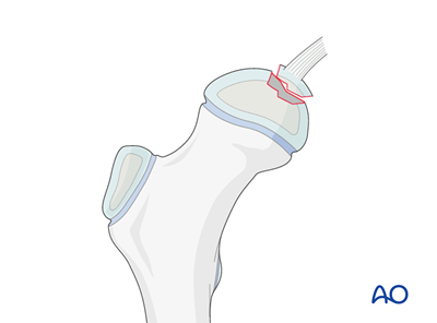 Open reduction, resorbable pin fixation for Avulsion of/by the ligament ...