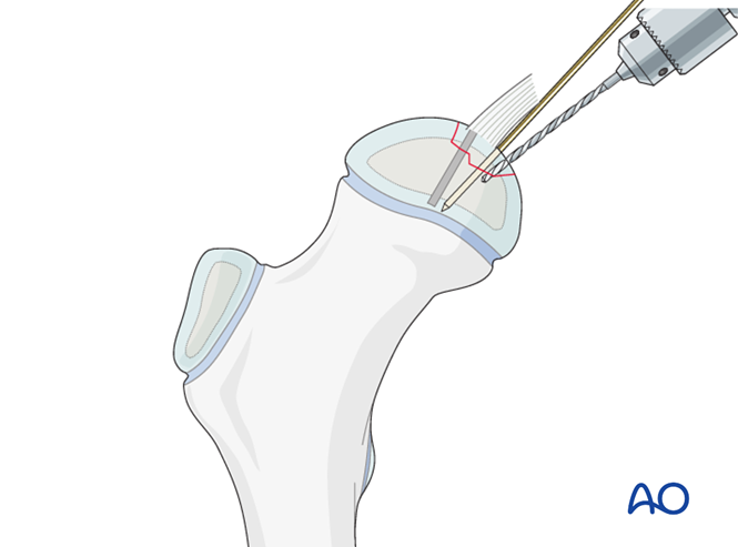 Open reduction, resorbable pin fixation for Avulsion of/by the ligament ...