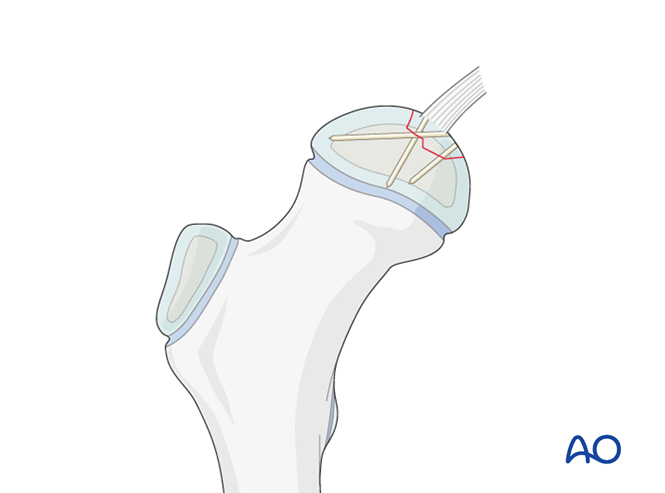 Open reduction, resorbable pin fixation for Avulsion of/by the ligament ...