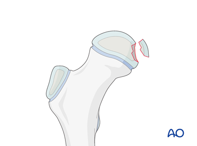 Open reduction, resorbable pin fixation for Intraarticular flake(s)