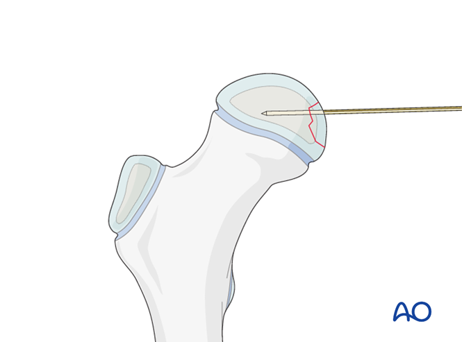 Open reduction, resorbable pin fixation for Intraarticular flake(s)