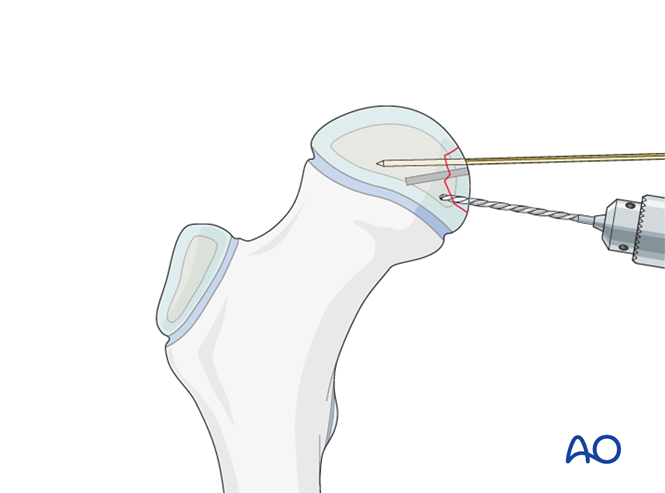 Open reduction, resorbable pin fixation for Intraarticular flake(s)