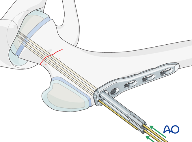 Pediatric hip locking plate for Incomplete midcervical