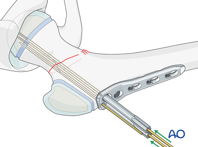 Pediatric hip locking plate for Incomplete basicervical