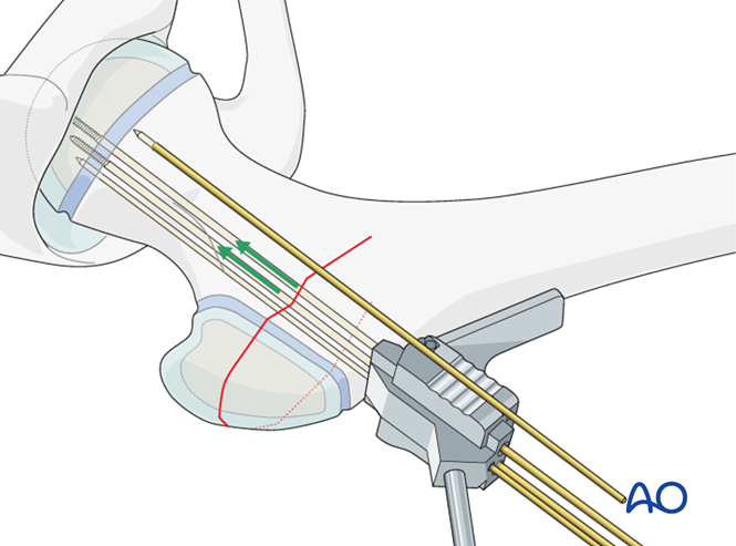 Pediatric hip locking plate for Incomplete transtrochanteric