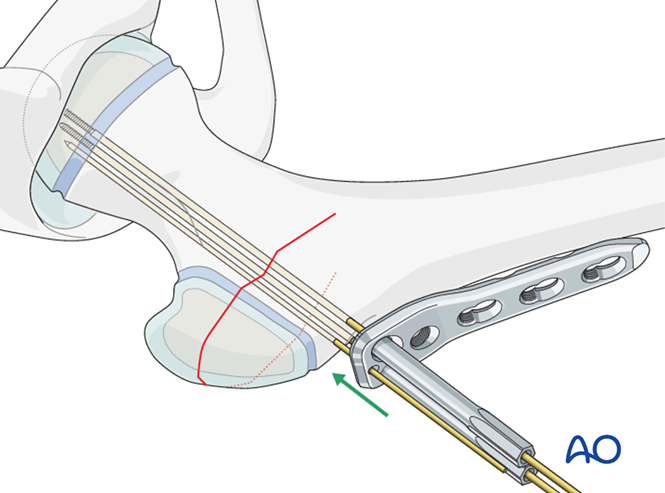 Pediatric hip locking plate for Incomplete transtrochanteric