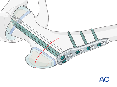 Pediatric hip locking plate for Incomplete transtrochanteric
