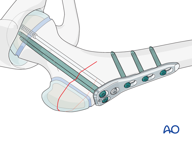 Pediatric hip locking plate for Incomplete transtrochanteric