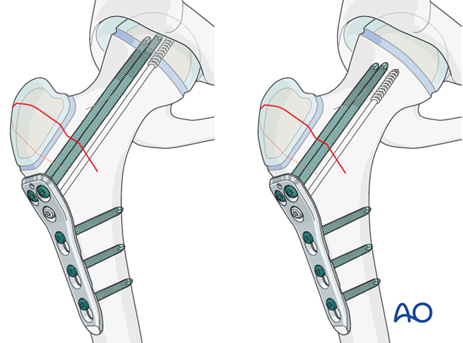 Pediatric hip locking plate for Incomplete transtrochanteric
