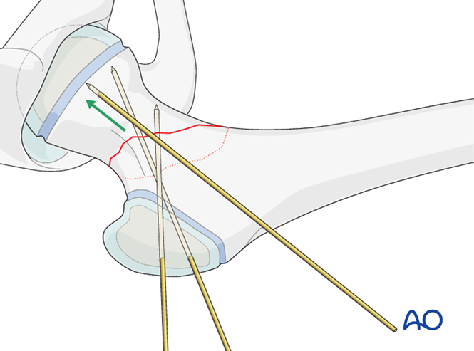 Open reduction, pediatric hip locking plate for Complete midcervical ...