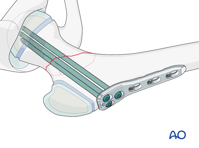 Open reduction, pediatric hip locking plate for Complete midcervical ...