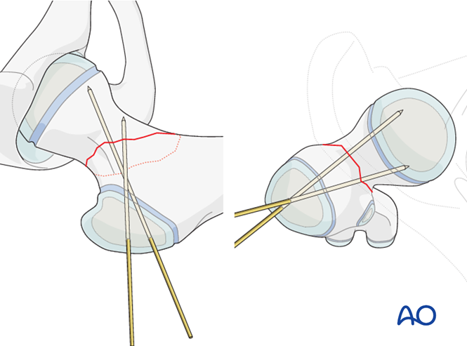 Open reduction, pediatric hip locking plate for Complete midcervical ...