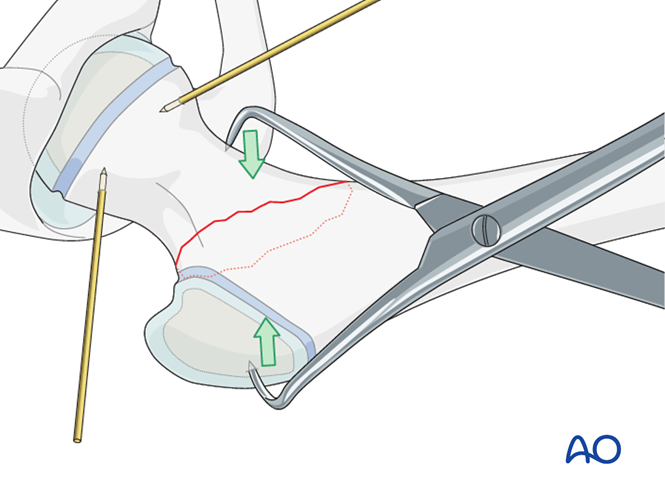 Open reduction, pediatric hip locking plate for Complete basicervical ...
