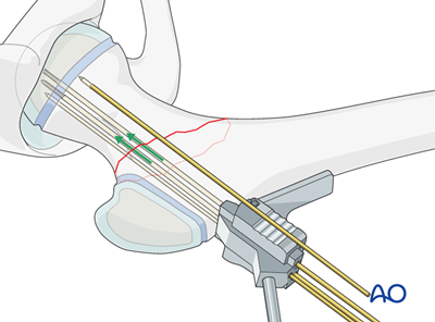 Open reduction, pediatric hip locking plate for Complete basicervical ...