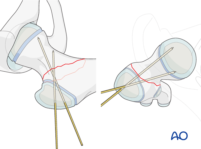 Open reduction, pediatric hip locking plate for Complete basicervical ...