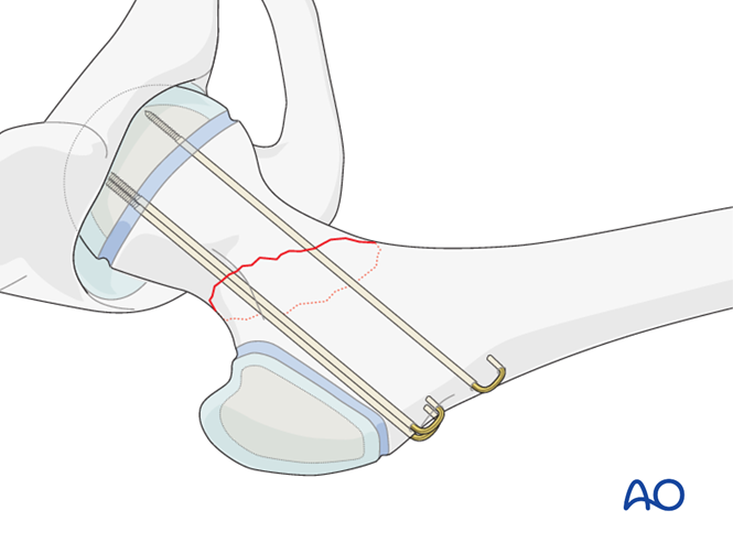 Open reduction, K-wire fixation for Complete midcervical, simple