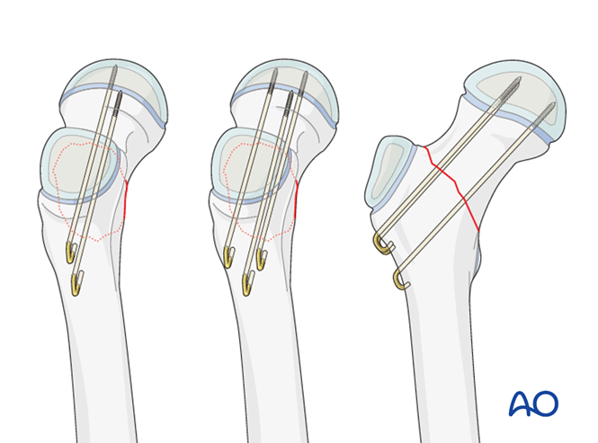 Open reduction, K-wire fixation for Complete basicervical, simple