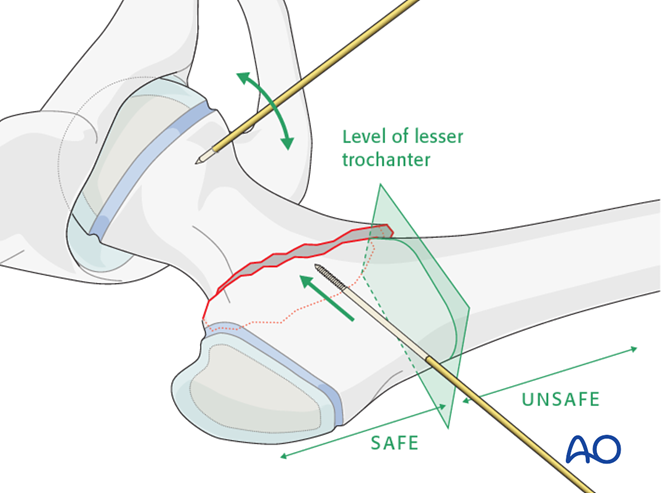 Open reduction, K-wire fixation for Complete basicervical, simple