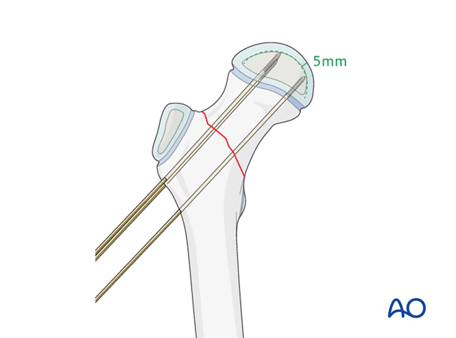 Open reduction, K-wire fixation for Complete basicervical, simple