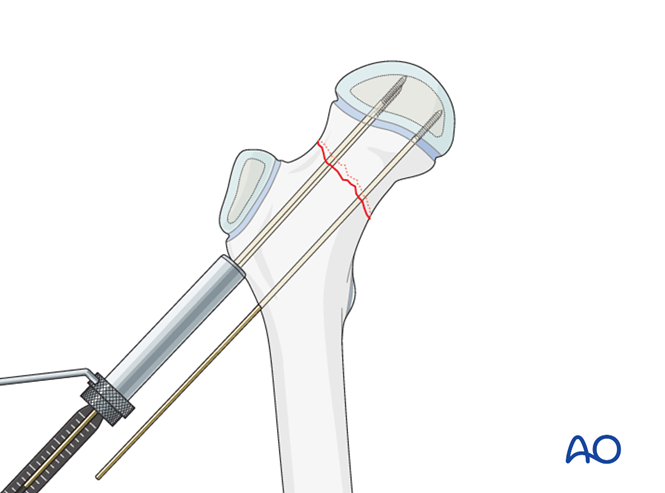 Open reduction, screw fixation for Complete midcervical, simple
