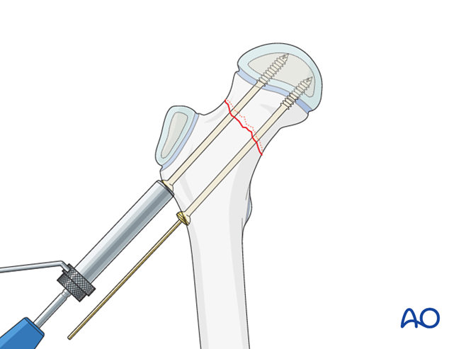 Open reduction, screw fixation for Complete midcervical, simple