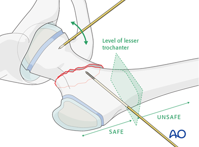 Open reduction, screw fixation for Complete midcervical, simple