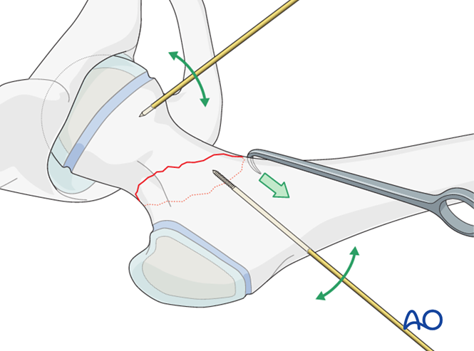 Open reduction, screw fixation for Complete midcervical, simple