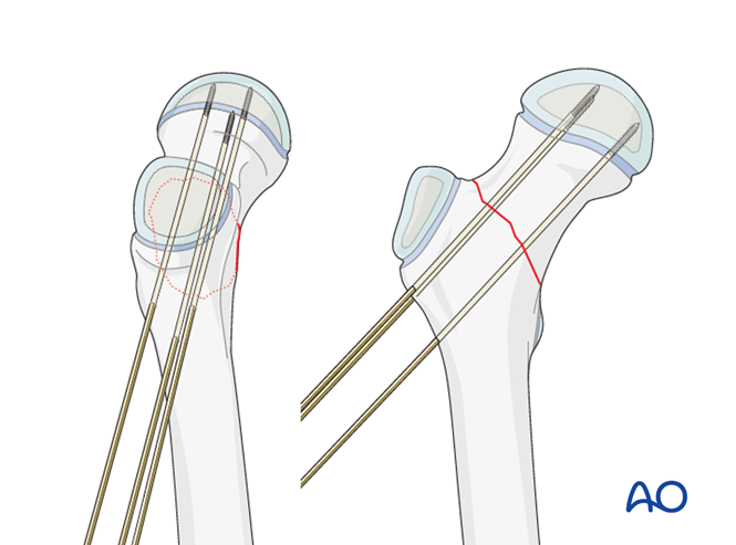 Open reduction, screw fixation for Complete basicervical, simple
