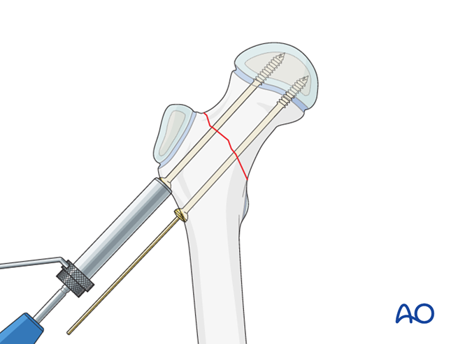 Open reduction, screw fixation for Complete basicervical, simple