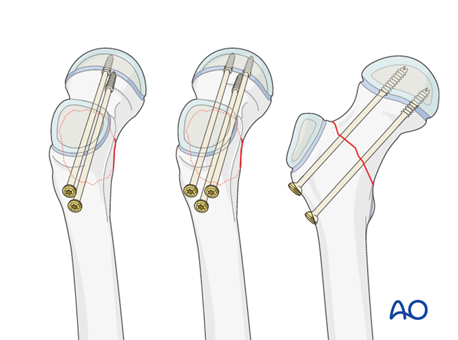 Open reduction, screw fixation for Complete basicervical, simple